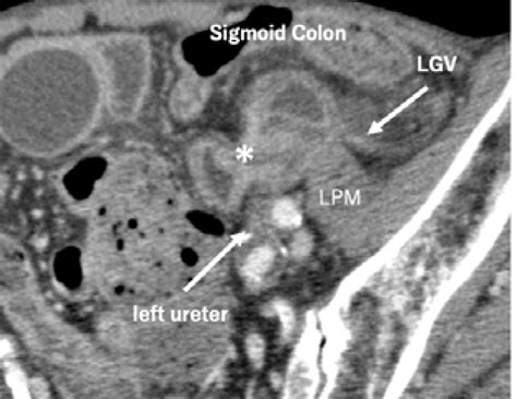 Computed Tomography Findings Of Intersigmoid Hernia