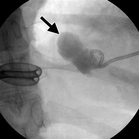 Image Guided Percutaneous Splenic Interventions Radiographics