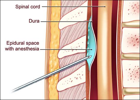 Epiduralanestesi Narkosguiden