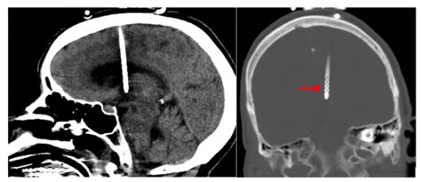 Neuroemcrit What Every Clinician Should Know About External