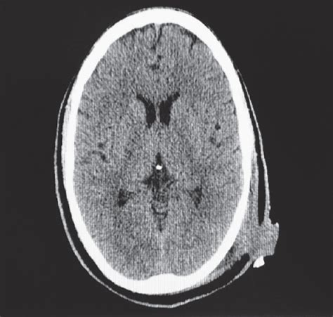 A Case Of Squamous Cell Carcinoma Of The Scalp In An African Man Consultant360