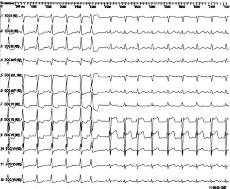 Twelve Lead Surface Ecg During The Last Radiofrequency Application