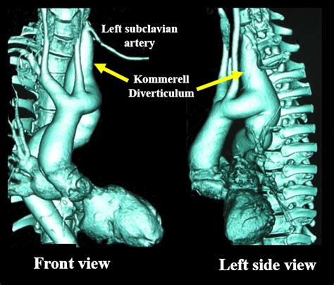Aberrant Left Subclavian Adult Congenital Aortic Syndrome Ejzv