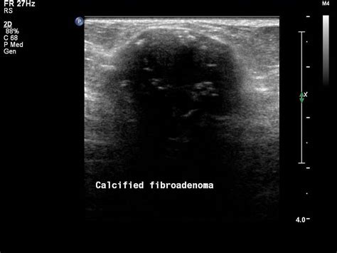 Atlas Of Breast Cancer Early Detection