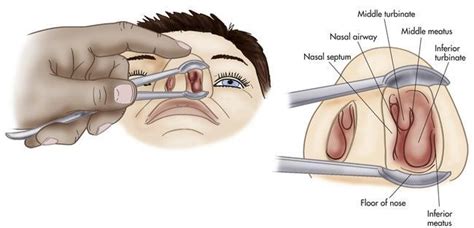 Turbinoplasty Otorhinolaryngology Ear Nose Throat