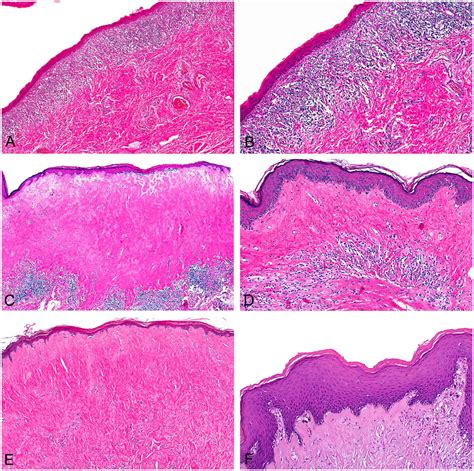 Lichen Sclerosis Histology