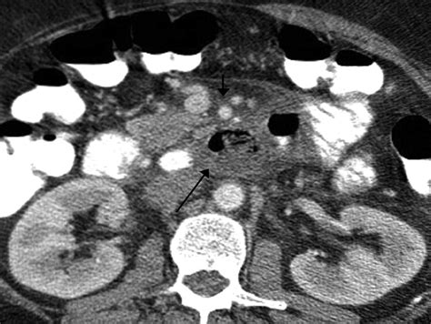 Ct Findings In Duodenal Diverticulitis Ajr