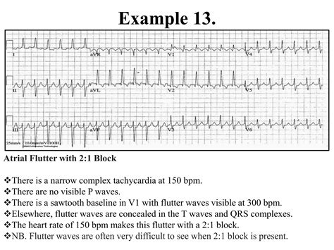 Atrial Fib And Flutter Pptx
