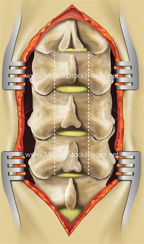 Step 1 Cervical Laminectomy Surgery Medical Stock Images Company