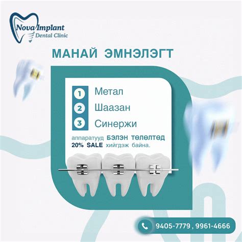 Шүдний аппарат бэлэн Nova Implant шүдний эмнэлэг