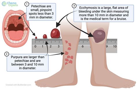 Ecchymosis Vs Petechiae Senile Purpura