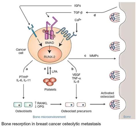 Metastatic Disease Of Extremity Pathology Orthobullets