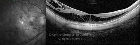 Degenerative Myopia Atlas Rl Eye