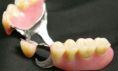 Metal Partial Denture Sydney Denture Clinic