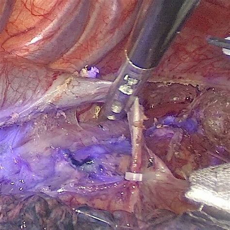 Icg Nir Image Guided Identification Of Esophageal Lymph Nodes A Icg⁺ Download Scientific