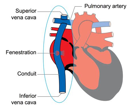 Stimulation Of Ventricular Stiffening Trough The Different Stages Of Single Ventricle Surgery