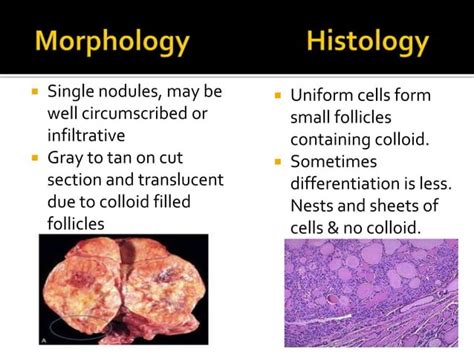 Neoplasms Of Thyroid Gland Pptx Thyroid Disorders Endocrine And