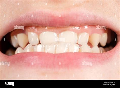 Patient With Gingival Smile Large Gums And Small Teeth Microdentia