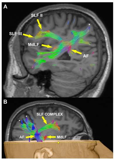 Supramarginal Gyrus And Angular Gyrus Subcortical Connections A