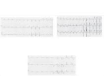 QT Abnormalities