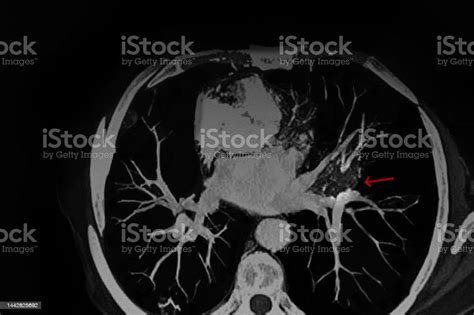 Foto De Imagem De Tomografia Computadorizada Angiografia Pulmonar