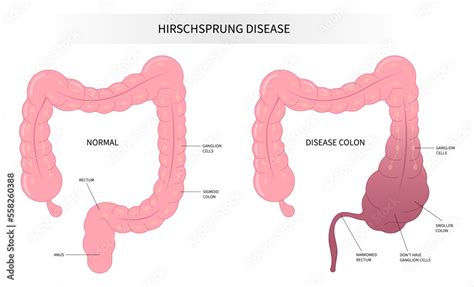 Intestinal Disease Of Hirschsprungs Nerves Inflammation Blocked