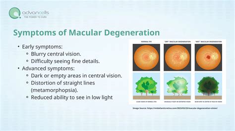 Symptoms Of Macular Degeneration And Age Related Macular Degeneration