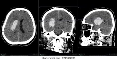 Intraventricular Hemorrhage Ct