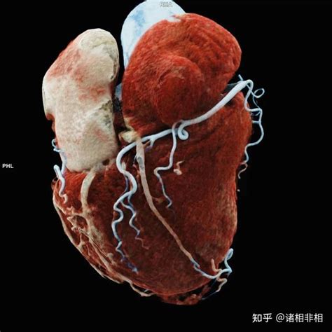 冠脉ct的新杀器——光子ct检查 知乎