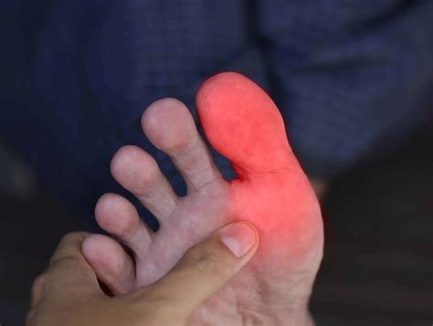 Podagra Uzrok Simptomi Liječenje Arzhr