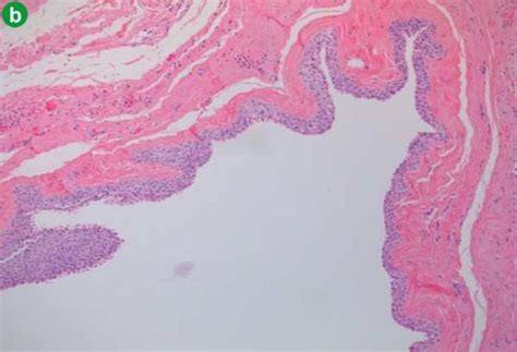 Squamoid Cyst Of Pancreatic Ducts Is Lined By Nonkeratinized Squamous
