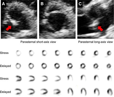 Aortic Valve Leaflets Echo