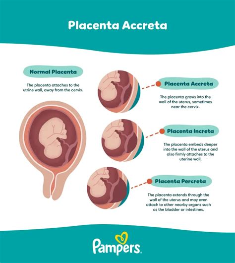 Placenta Accreta Causes Risks And Treatment Pampers Uk