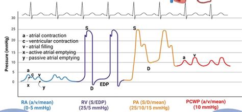 Understanding Ra Rv Pa And Pcwp Waveforms Ibrahim Elmalla Md