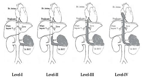 Shows Levels Of Renal Vein And Ivc Thrombus Download Scientific Diagram