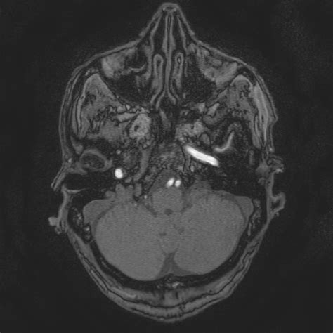 Neurovascular Compression Of Trigeminal Nerve Radiopaedia 67922 77361 Axial Mra Nc Commons