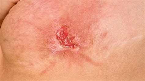 ¿cómo Curar Una Herida Infectada Y Prevenir Complicaciones Esalud