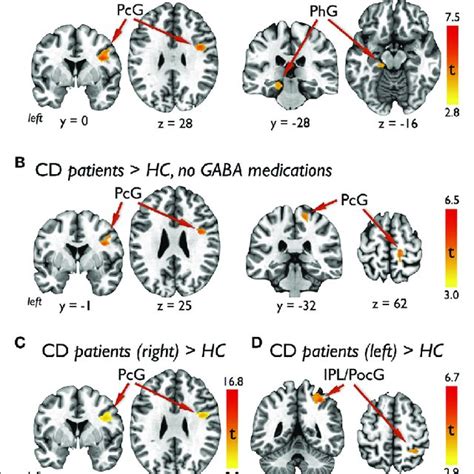 Results Of Voxel Based Regression Analyses Showing A Significant