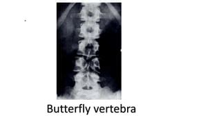 Congenital Anomalies And Degenerative Conditions Of Vertebra Pptx