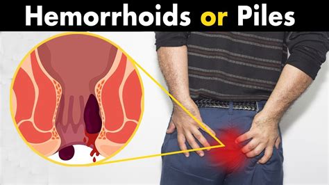 What Are Hemorrhoids Piles Symptoms Diagnosis And Treatment Youtube