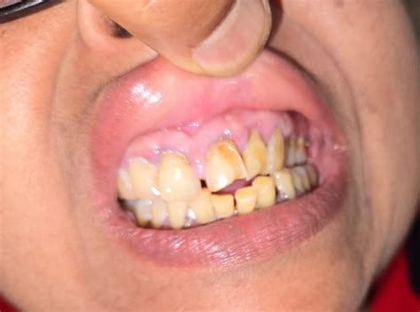 Was Gingival Hypertrophy Induced By Vildagliptin Cme India