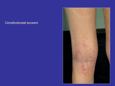 Ppt Eczeem Powerpoint Presentation Free Download Id 1399332