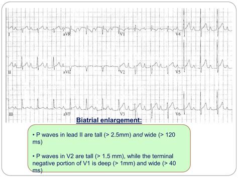 P Wave Ecg Dr Akif Baig Pptx