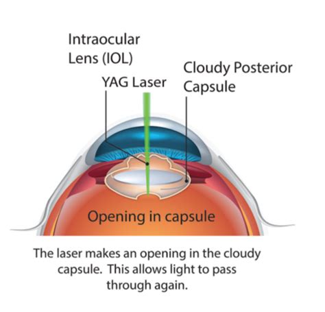 Laser Capsulotomy Risks At Tyler Mckinley Blog