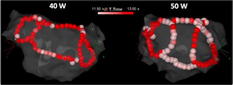 Example Of Carto Maps For Ablation Index Guided 50 W Right And 40 W