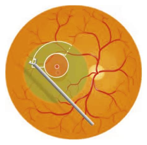 Schematic Drawing Of The Inverted Pedicled Internal Limiting Membrane Download Scientific