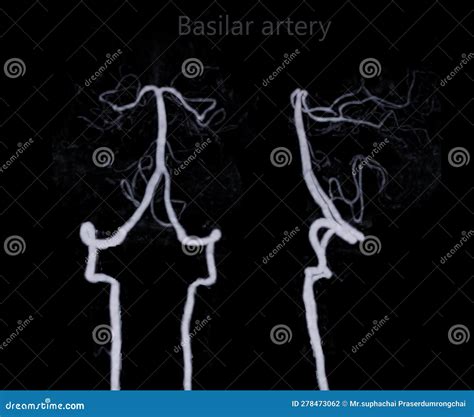 Ct Angiography Of The Brain Or Cta Brain Showing Basilar Artery Stock