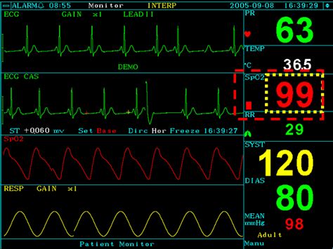Ot Black Box Spo2 Level Monitoring Bsm