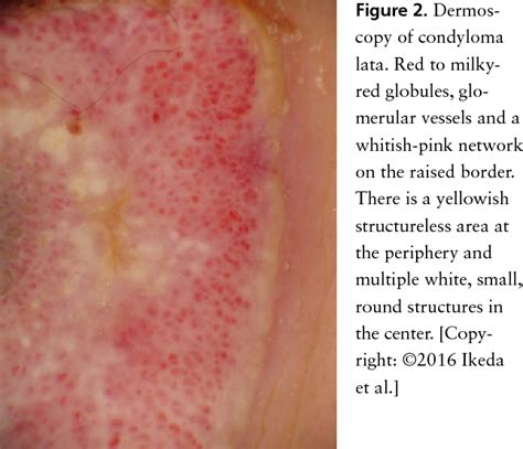Figure 1 From Condylomata Lata On The Ankle An Unusual Location
