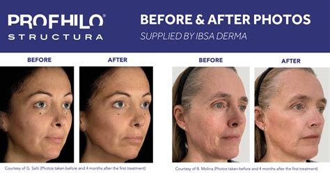 What Is Profhilo Structura New Regenerative Skin Injectable
